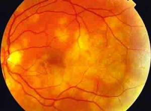 Oftalmología – Epiteliopatía pigmentaria placoide multifocal posterior ...